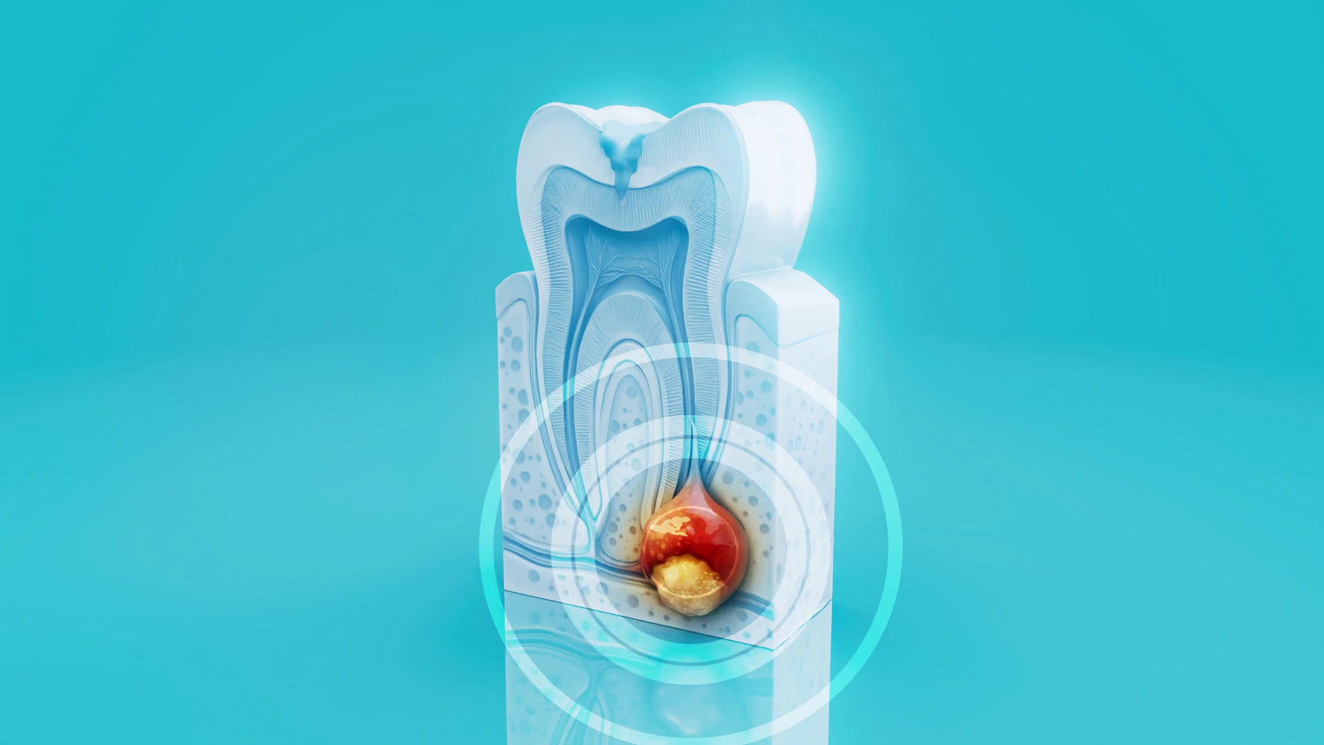 Conceptual 3d Animation Of Dental Abscess Stock Footage SBV-352907535 ...